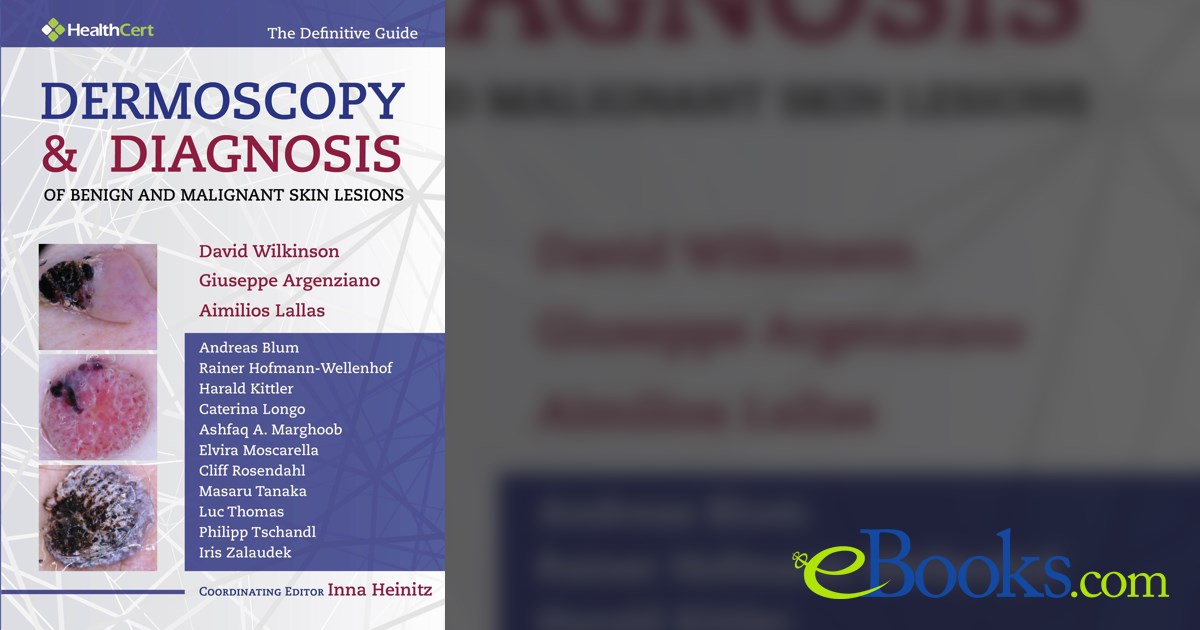 Dermoscopy and Diagnosis of Benign and Malignant Skin Lesions