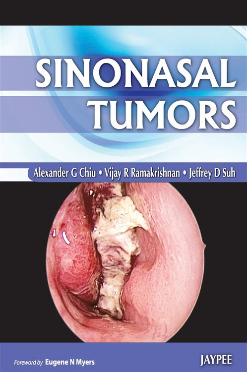 Sinonasal Tumors by Alexander G. Chiu (ebook)