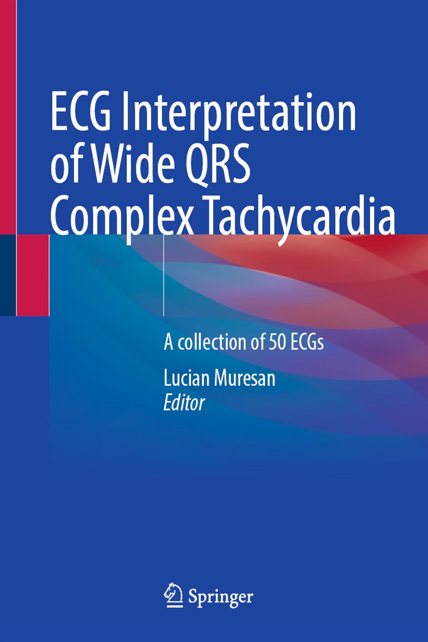 ECG Interpretation of Wide QRS Complex TachycardiaÂ