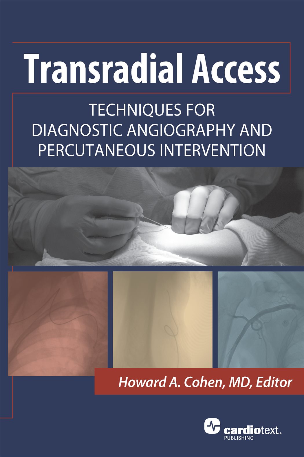 Transradial Access: Techniques for Diagnostic Angiography and ...