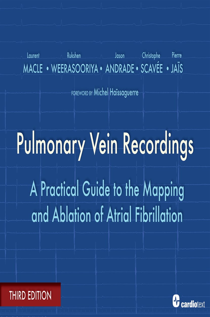 Pulmonary Vein Recordings : A Practical Guide to the Mapping and ...